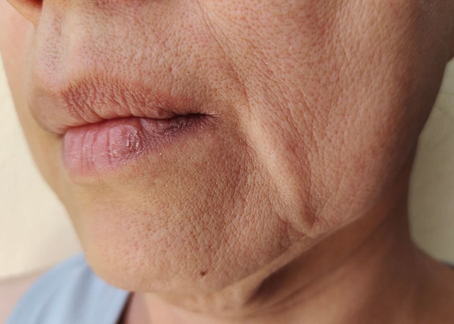 Facial Volume Loss Mediface Aesthetics Skin Care Doncaster