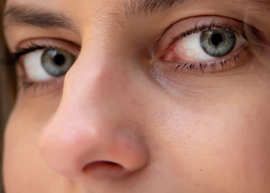 Mis-Shapen Nose | Mediface Aesthetics | Skin Care | Doncaster